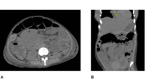 Radiologia Do Megacolon Toxico Colite Ulcerativa: Tipos, Sintomas,